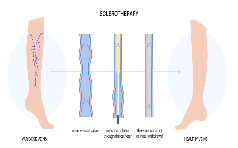 Sclerotherapy for Spider Veins in Los Angeles- Real results